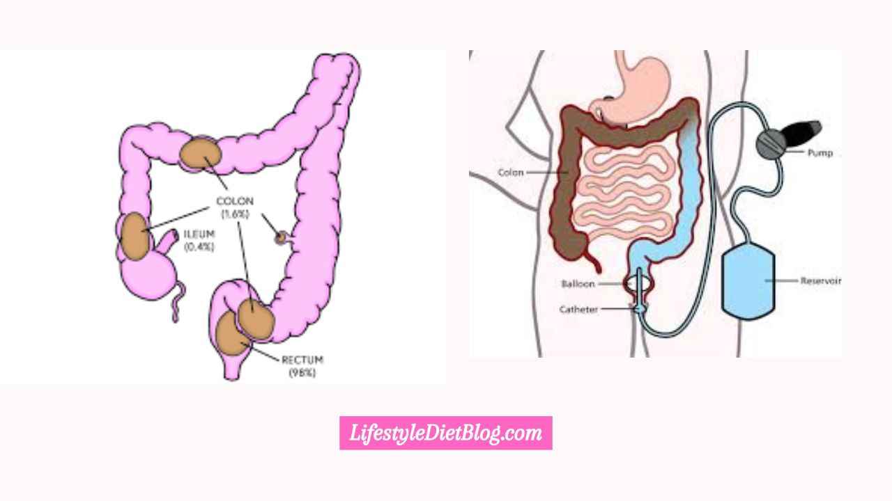 What Is Paradoxical Diarrhea