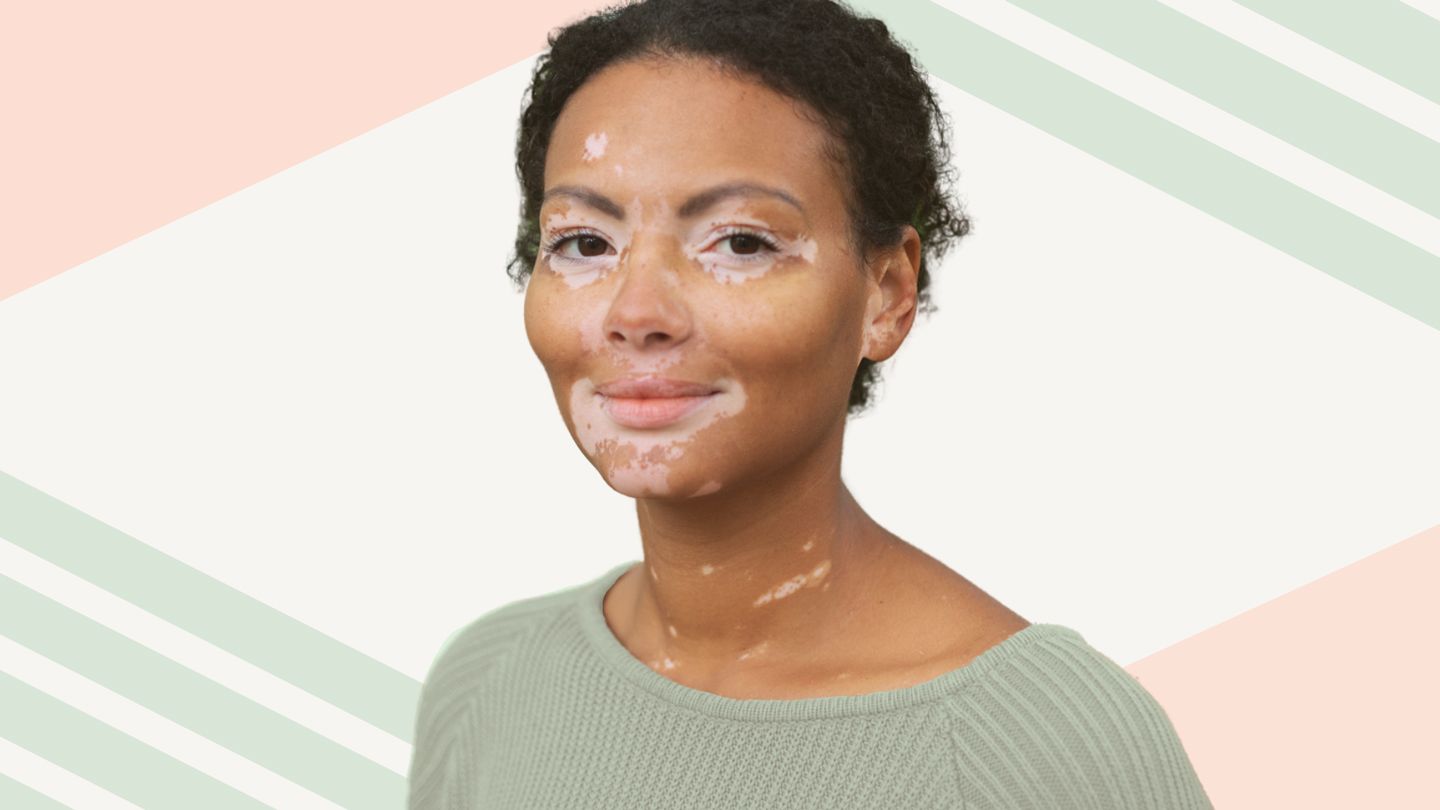 How To Treat Vitiligo Eczema