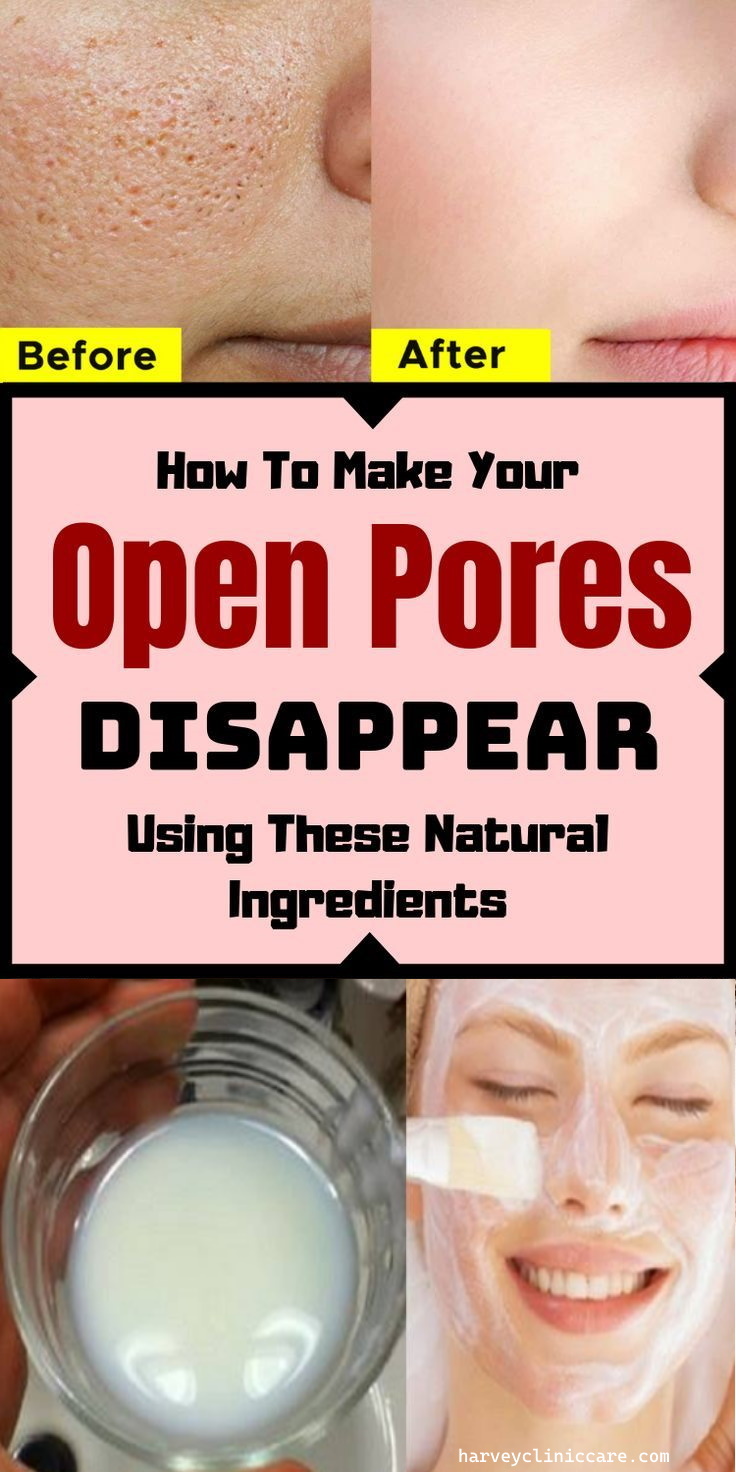 This 6 Easy Home Remedies To Get Rid Of Enlarged Pores On Your Face