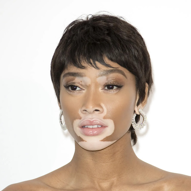 What Is Vitiligo Symptoms Causes Diagnosis And More