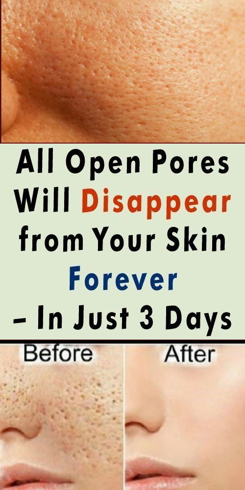 All Open Pores Will Disappear From Your Skin Forever In Just 3 Days