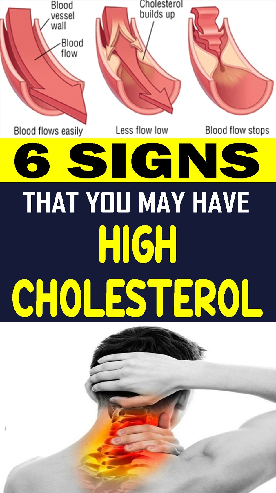 6 Signs That You May Have High Cholesterol Healthy Lifestyle