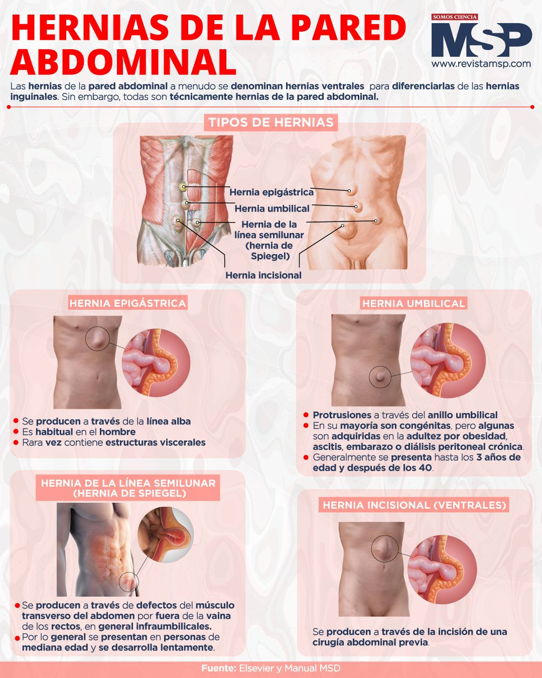 Hernias De La Pared Abdominal Infografía By Msp Med Tac