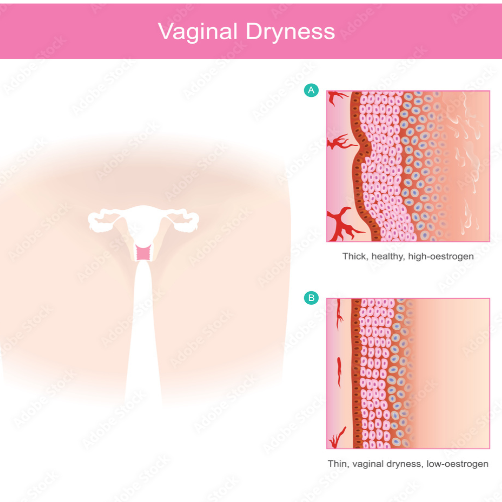 Vaginal Dryness Causes Symptoms Treatment And Ways To Prevent