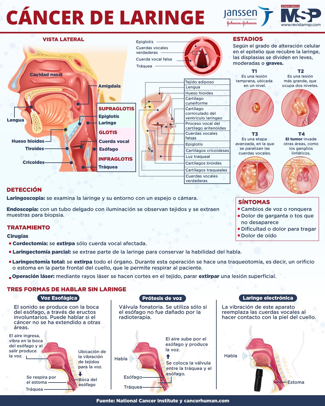 Cancer De Laringe Infografía By Msp Med Tac International Corp