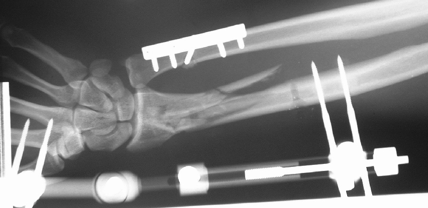 External Fixation A Revolutionary Method For Fracture Treatment