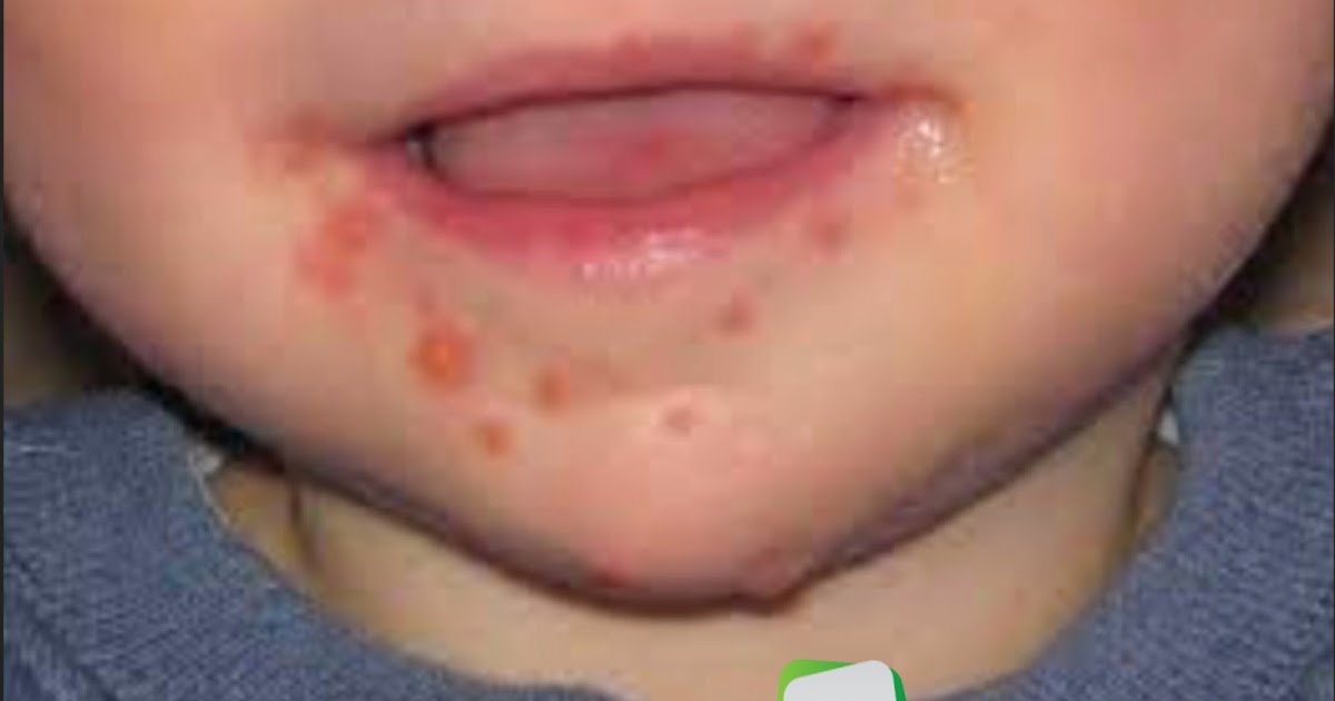 Mouth Rashes Understanding The Causes And Treatment