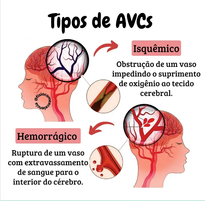 Tipos Acidente Vascular Cerebral Avcs Arte No Papel Online