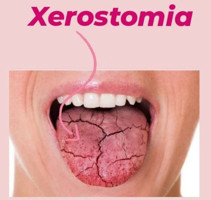 Xerostomia Or Dry Mouth Introduction Causes And Pathophysiology