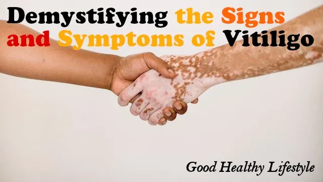 Understanding The Signs And Symptoms Of Vitiligo