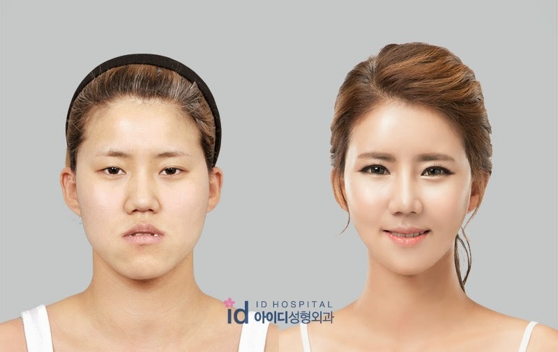 Id Hospital Korea Korea Orthognathic Surgery Double Jaw Surgery Two