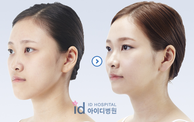 Id Hospital Korea Two Jaw Surgery In Korea Mandible Prognathismone