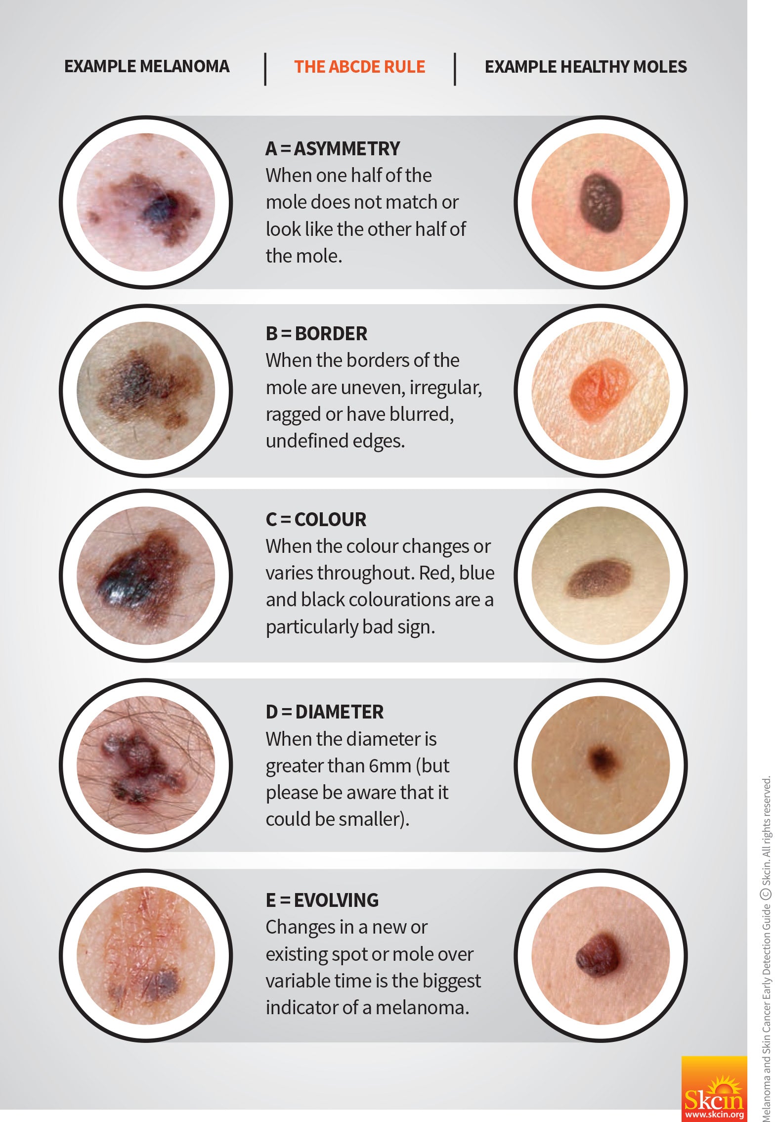 Skin Cancer Early Detection