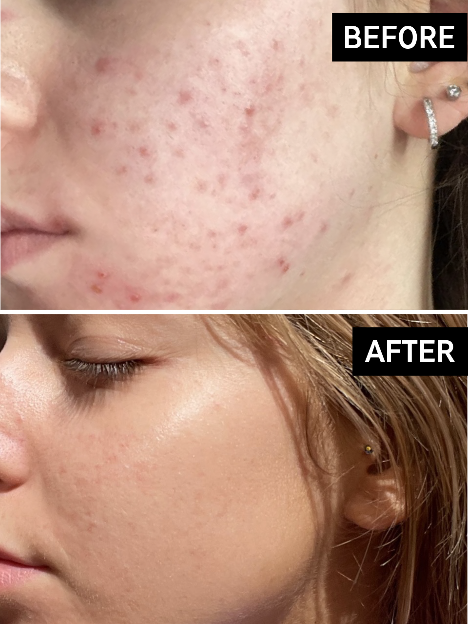 Salicylic Acid Acne Before And After