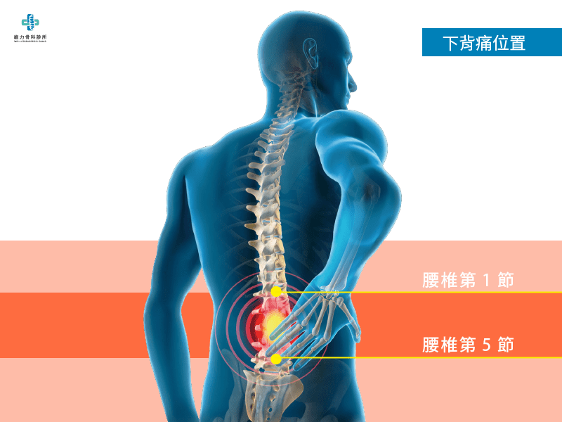 總是腰痠？腰痛？圖解下背痛位置與常見原因（上）