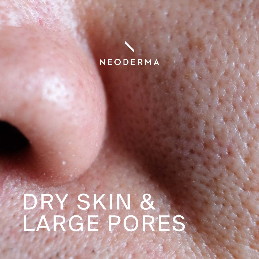 Dry Skin And Large Pores Neoderma