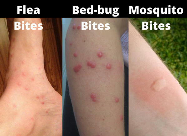 Bed Bug Vs Flea Bites