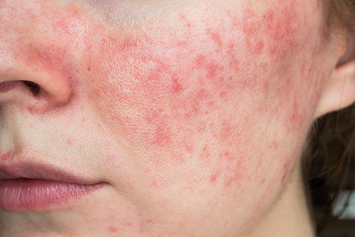 Decoding Facial Skin Redness Causes And Conditions Roccoco Roccoco