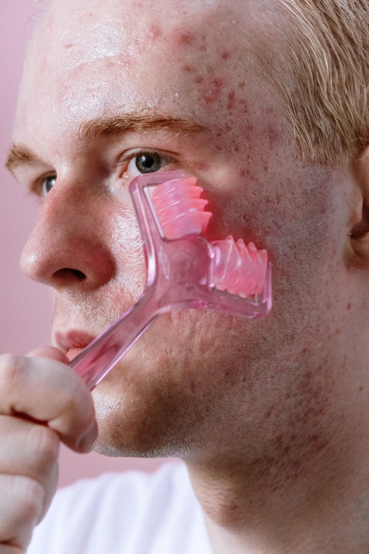 Tips For Treating Rosacea In Men