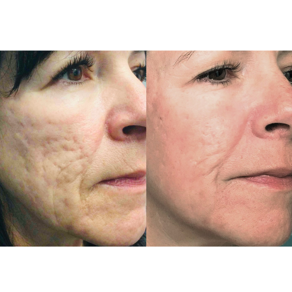 Tetra Coolpeel® Co2 Laser Skin Resurfacing Restoremd