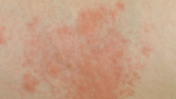 Hives Vs Rash How To Tell The Difference Dermeleve®