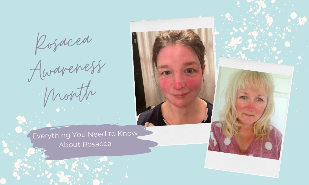 Everything You Need To Know About Rosacea Rosalique Skincare Europe