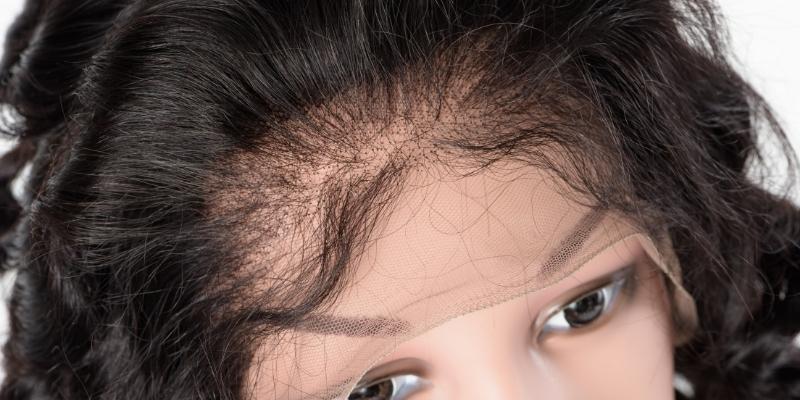 Cranial Prosthesis Recommendations By Hair Loss Type Wig Medical