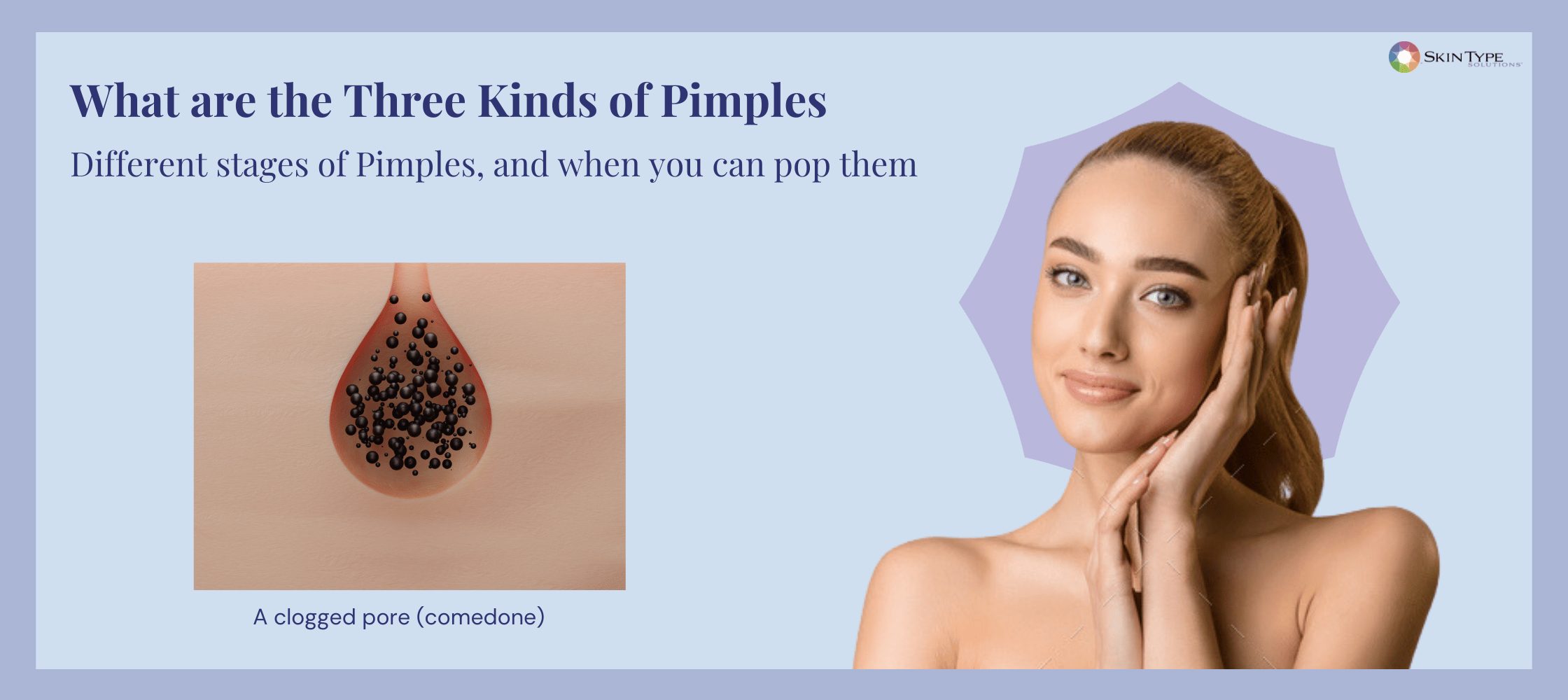 What Happens If You Dont Pop Your Pimples Skin Type Solutions