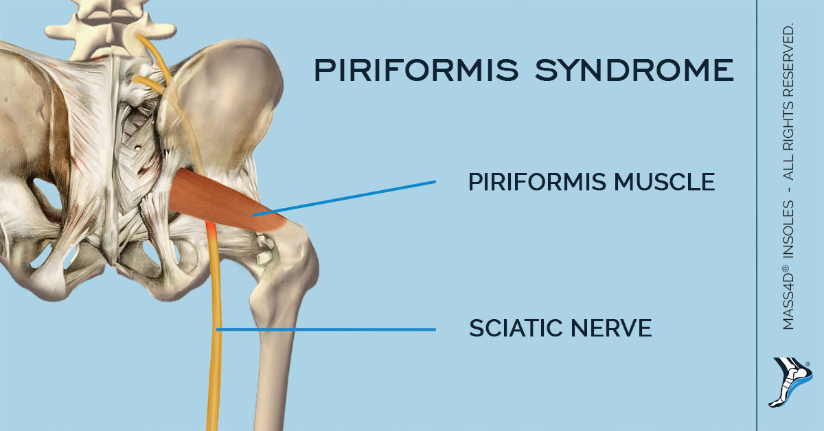 What Is Piriformis Syndrome Mass4d® Foot Orthotics