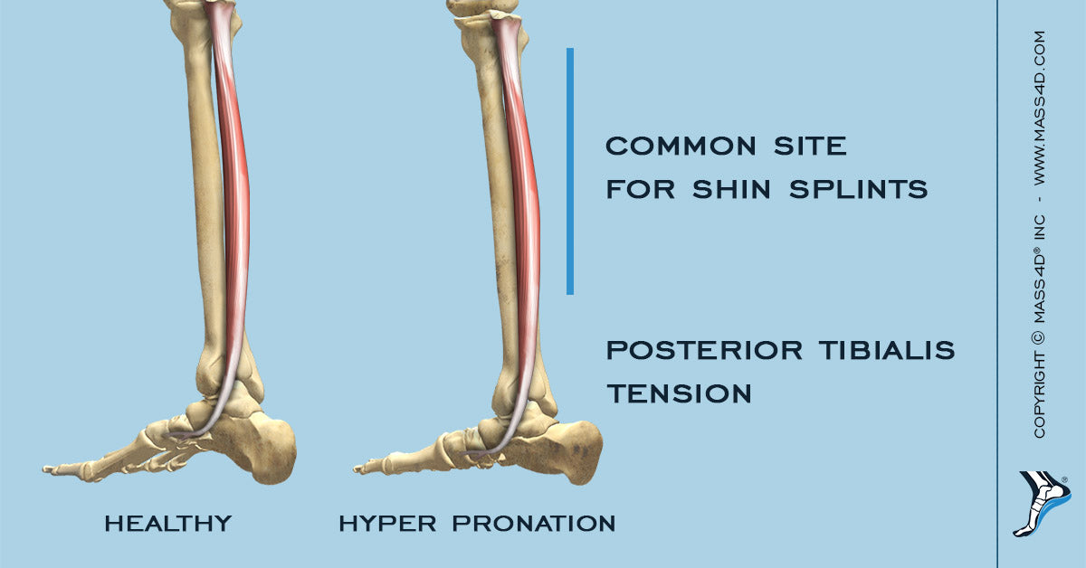 Anterior Tibialis Tendonitis