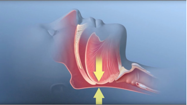 Central Vs Obstructive Sleep Apnea What Are The Main Differences