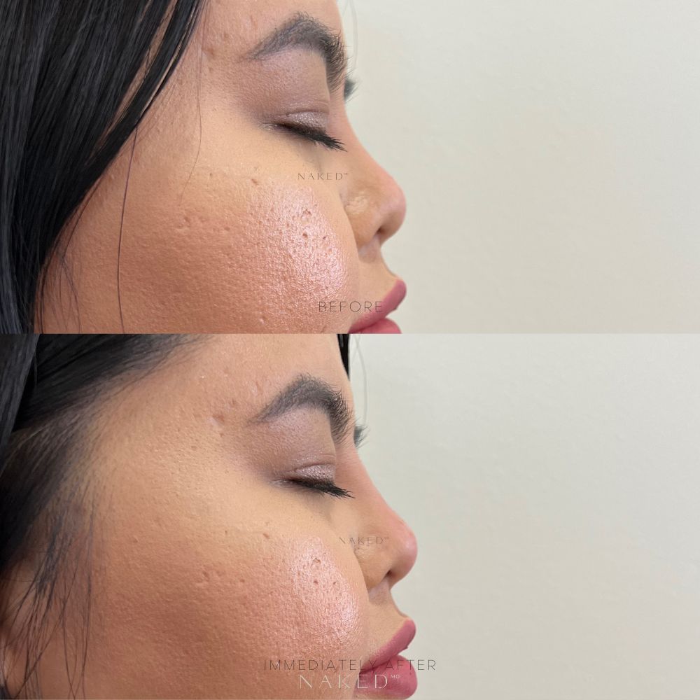 Non Surgical Nose Job In Orange County And San Bernardino Ca