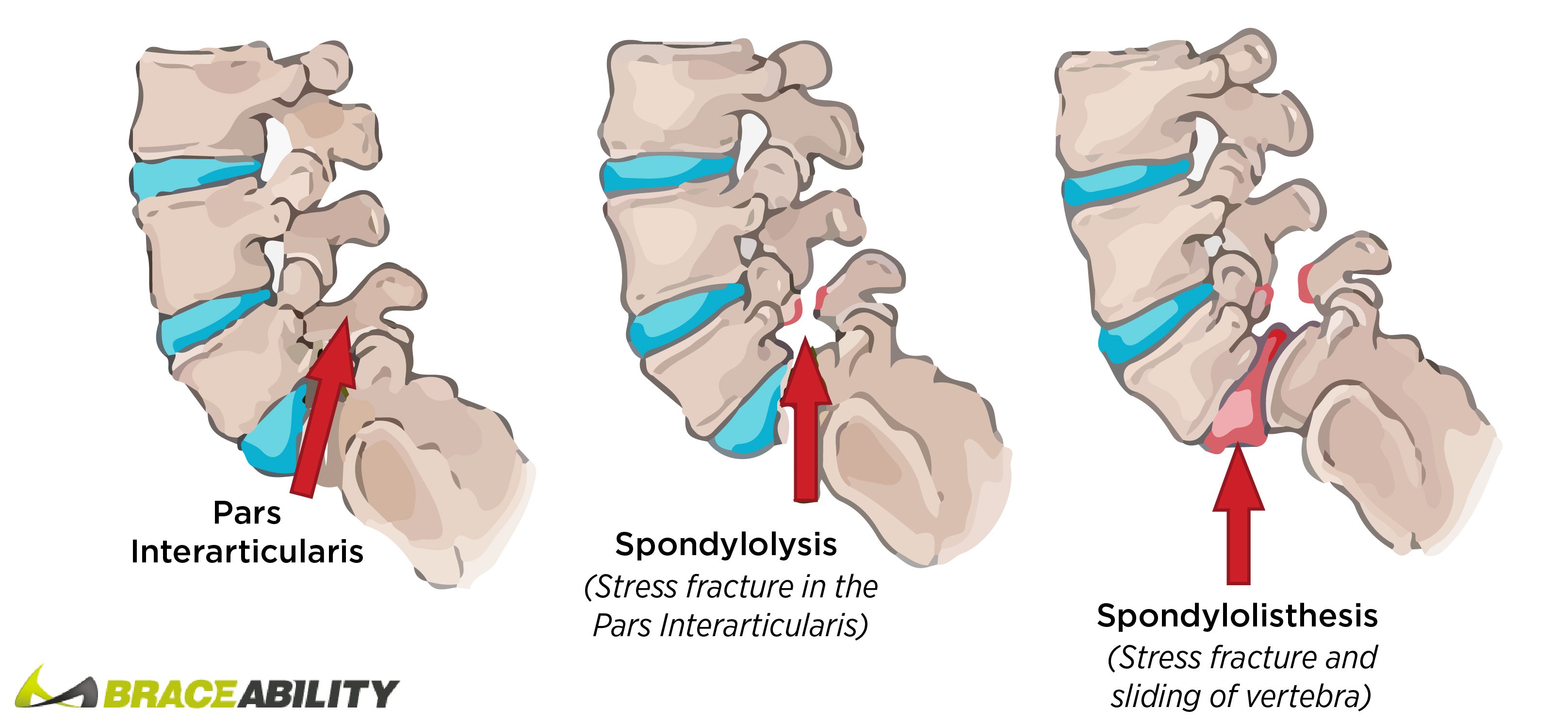 Spondylolysis Of The Lumbar Spine Symptoms Causes And Treatments