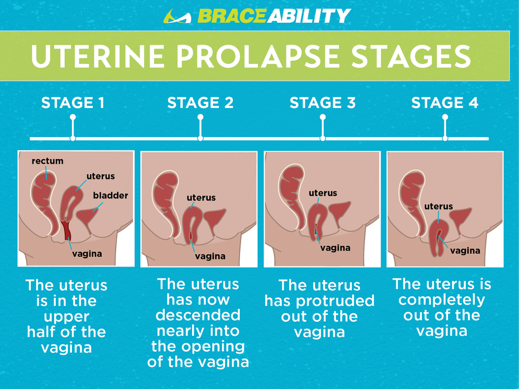 Uterine Prolapse Pictures