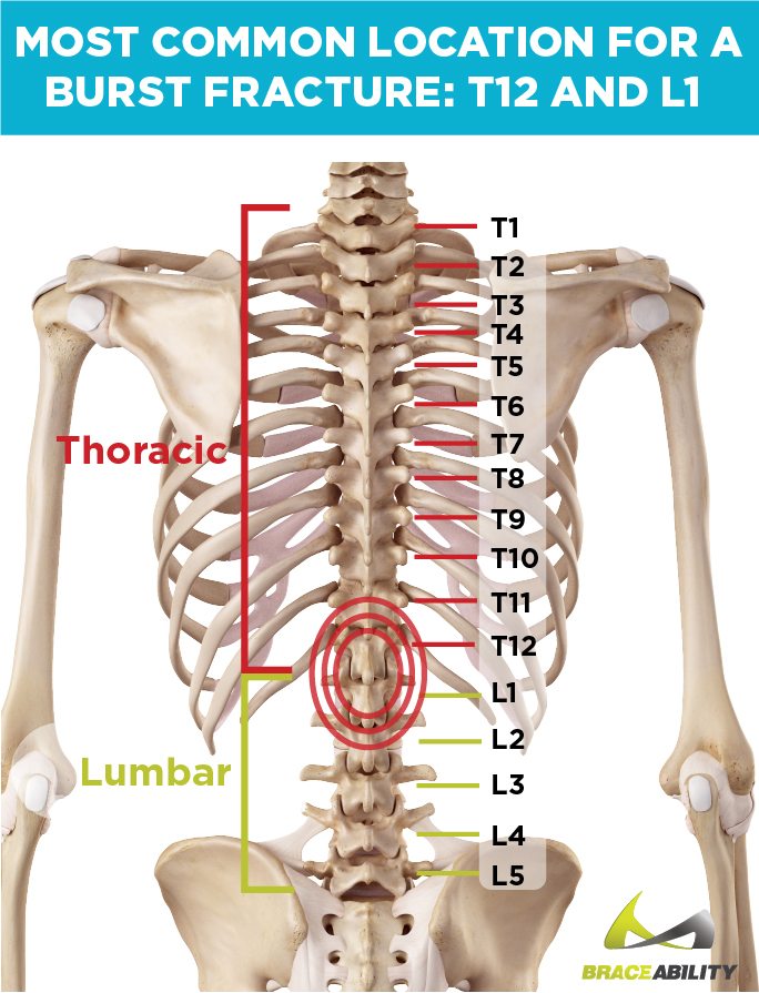 L1 Vertebrae Fracture