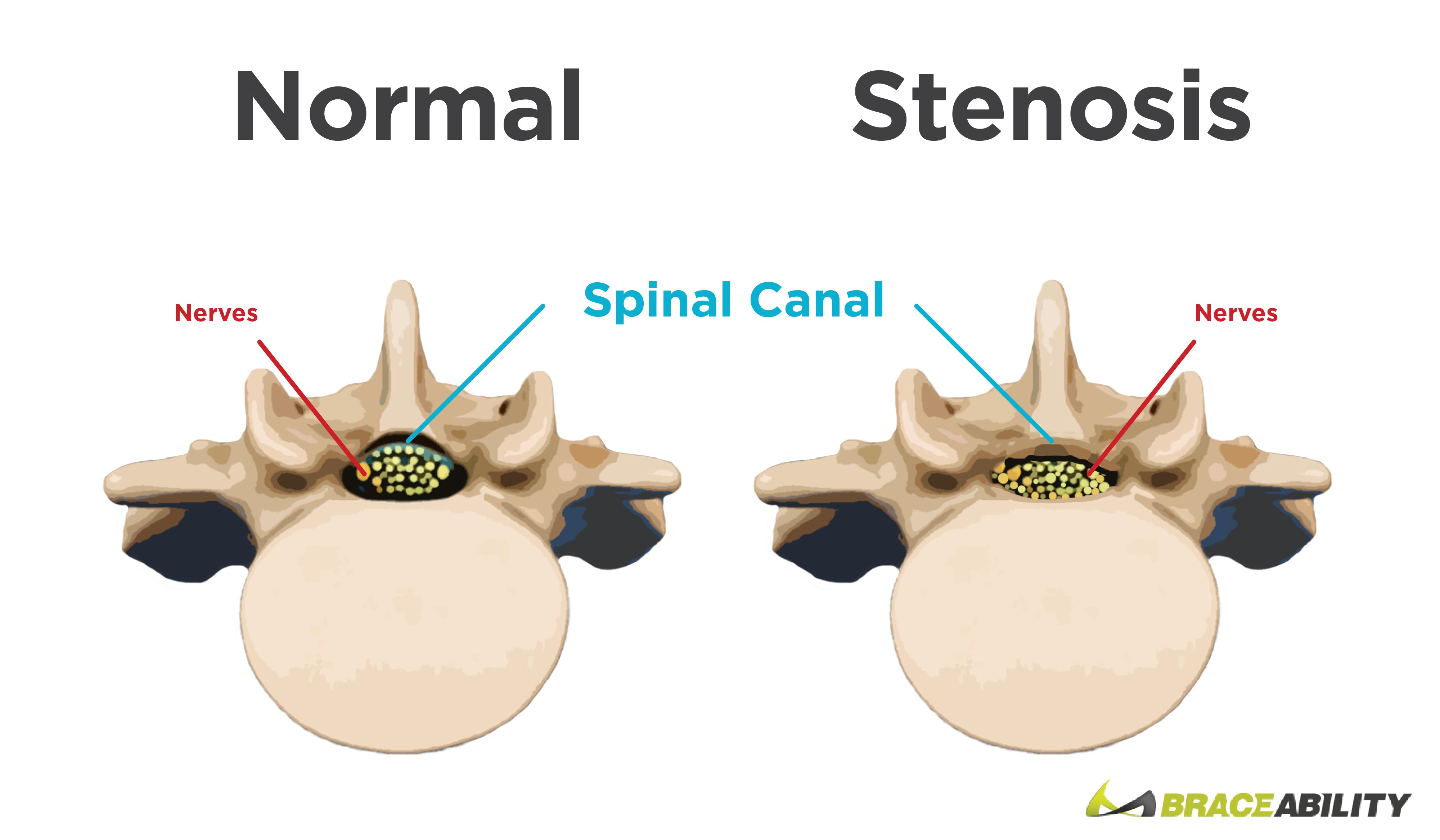 Spinal Stenosis What Causes Narrowing Of Your Spine Or Backbone