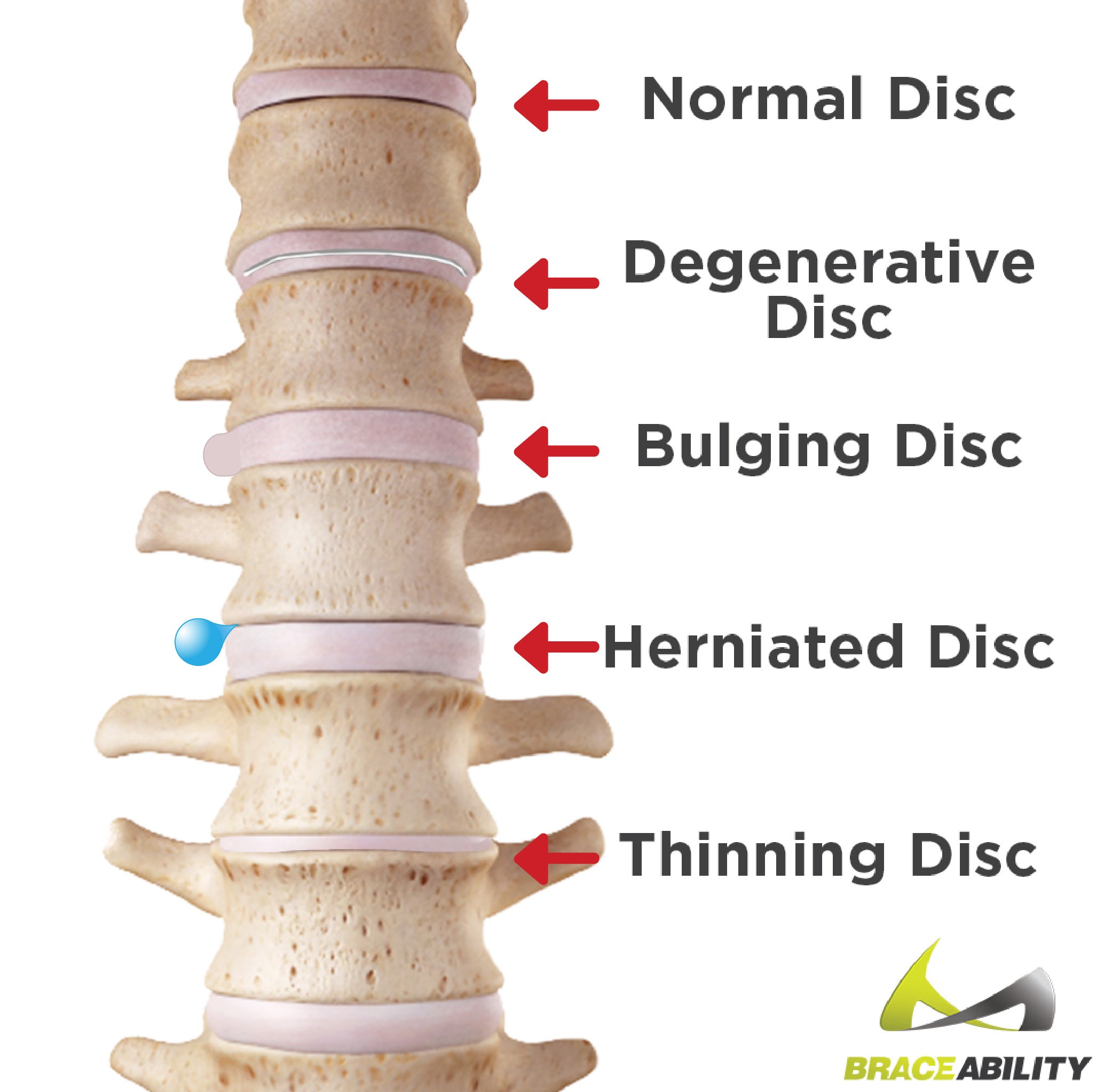 The Difference Between Herniated And Bulging Discs Beacon Orthopaedics