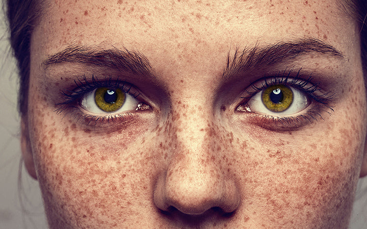 How To Reduce Hyperpigmentation With Ayurvedic Treatments Vedix