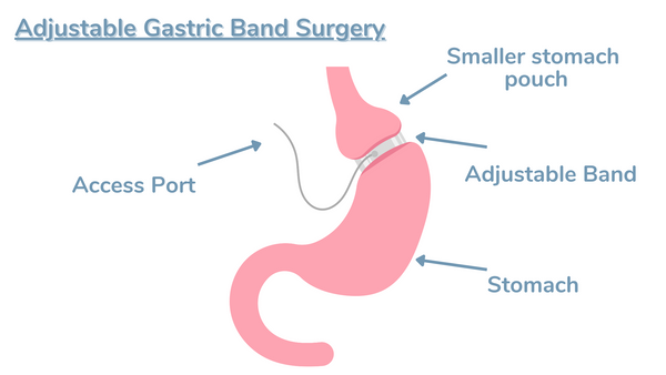 The Ultimate Guide To Gastric Banding Surgery Everything You Need To