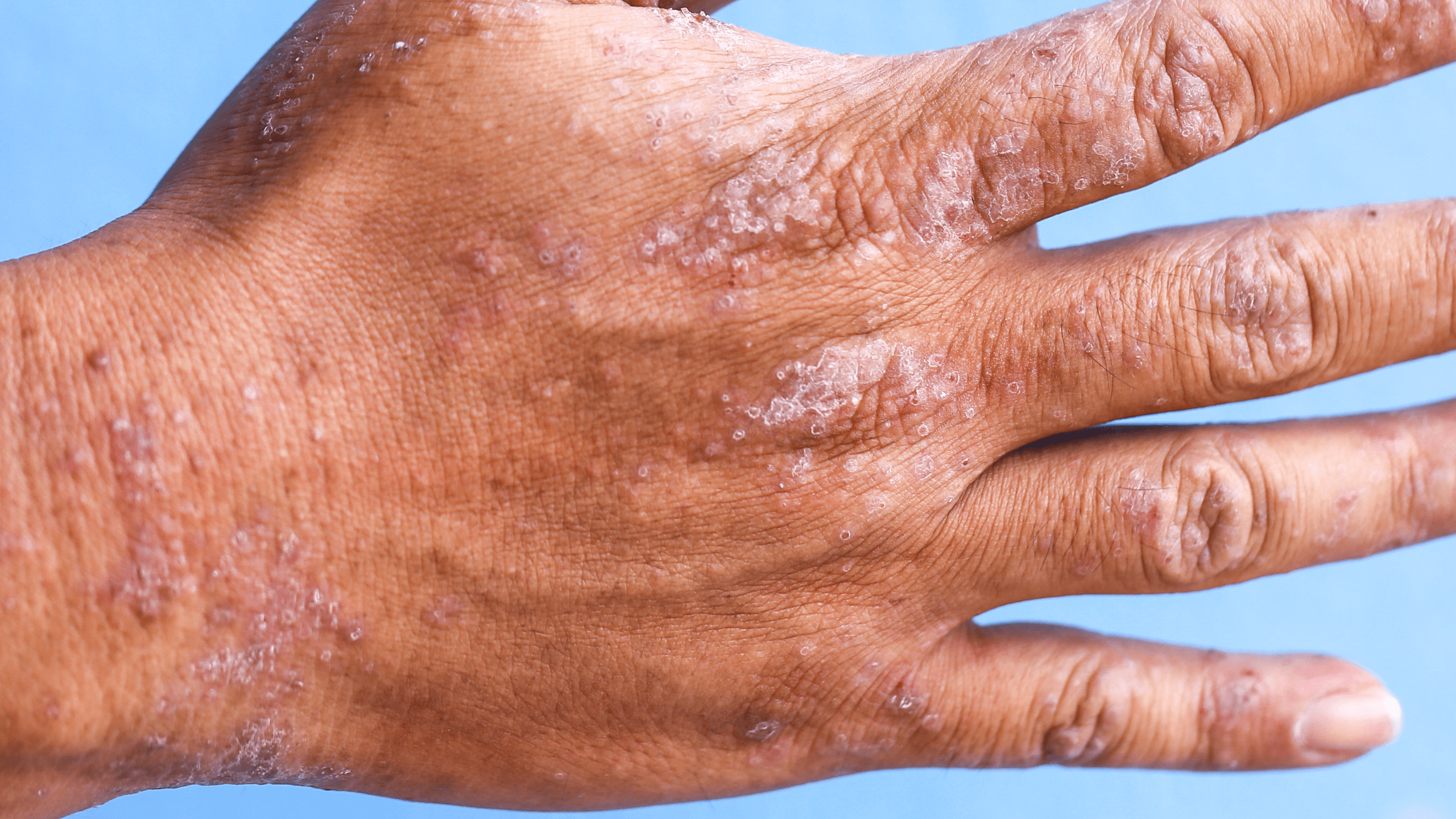 Types Of Eczema Contact Dermatitis Gladskin