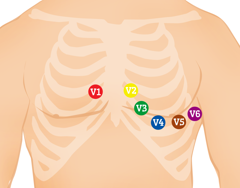 12 Lead Ecg Placement Guide With Illustrations