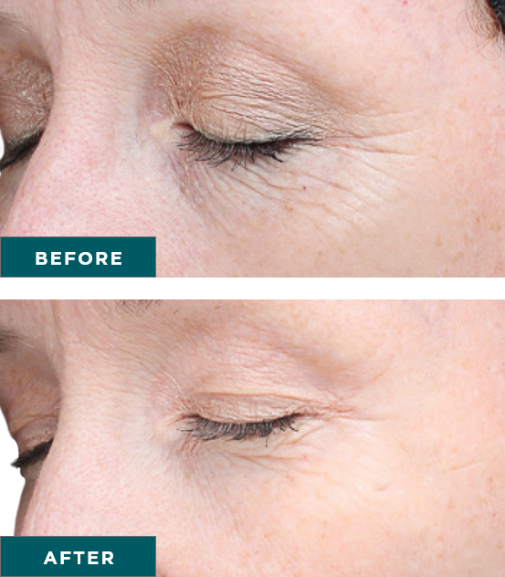 Patient Results Vi Derm Beauty