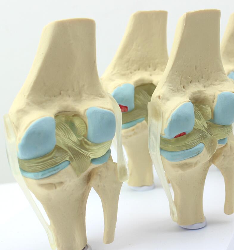 4 Stage Osteo Osteoarthritis Knee Model Set Sjxbx