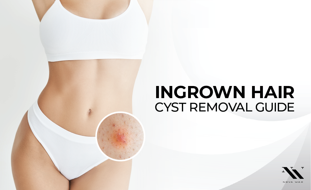 How To Treat And Remove Ingrown Hair Cysts Nova Wax