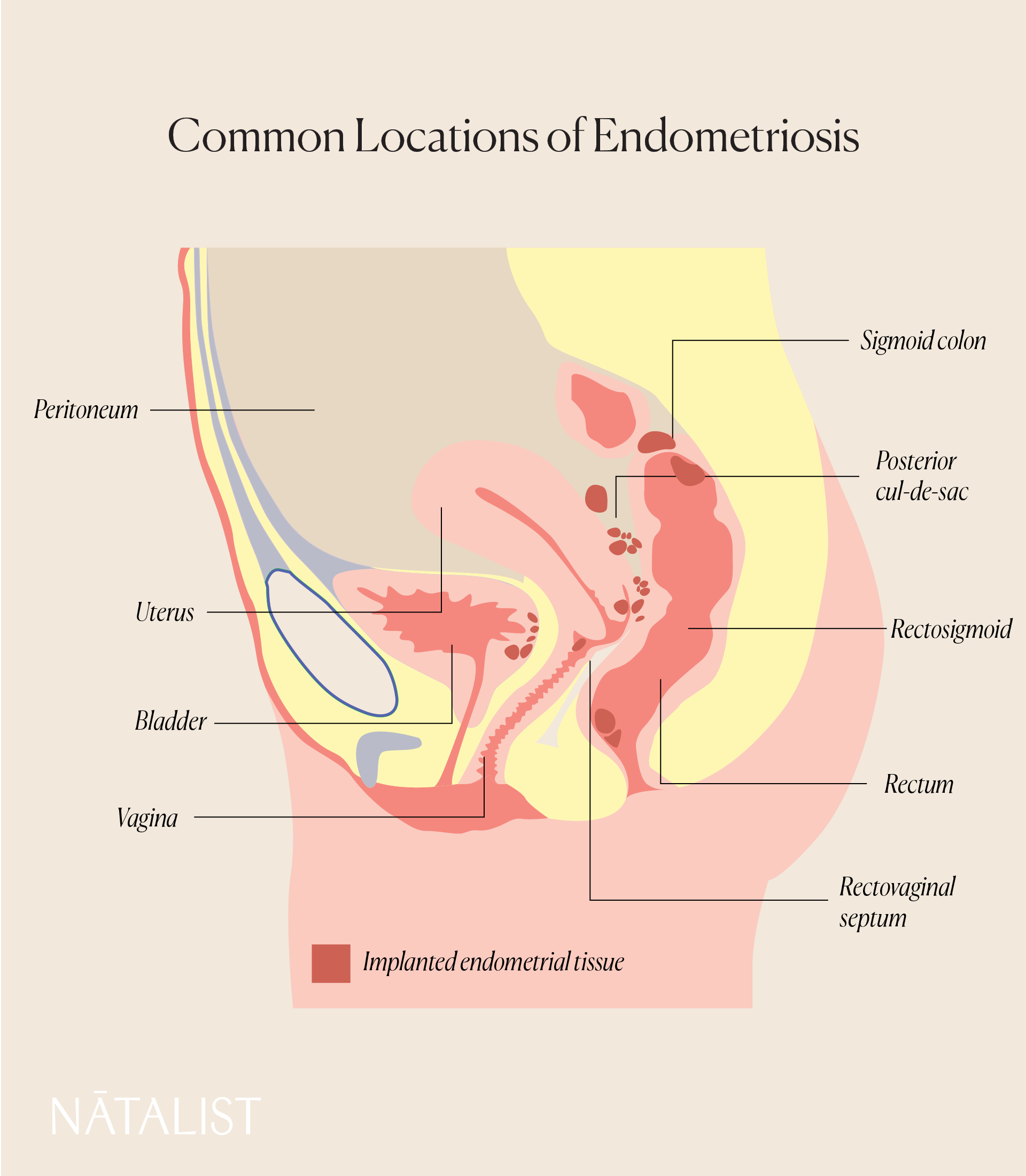 Endometriosis And Its Effect On Fertility And Pregnancy Natalist