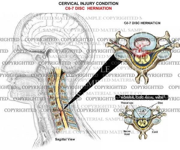 C6 7 Disc Herniation — Medical Art Works