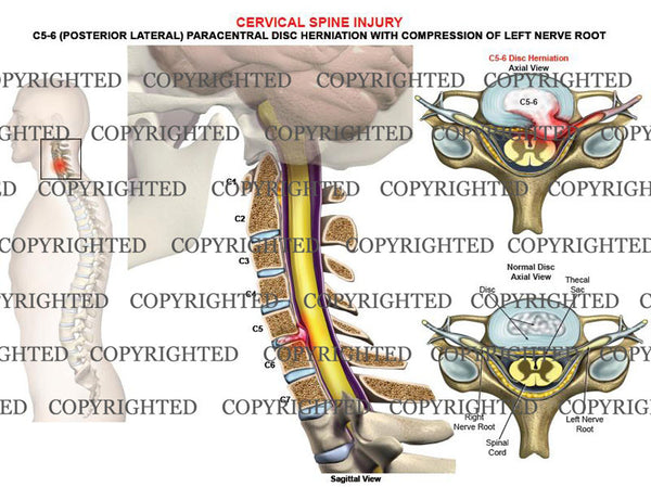 C5 6 Left Posterolateral Paracentral Disc Protrusion Male — Medical