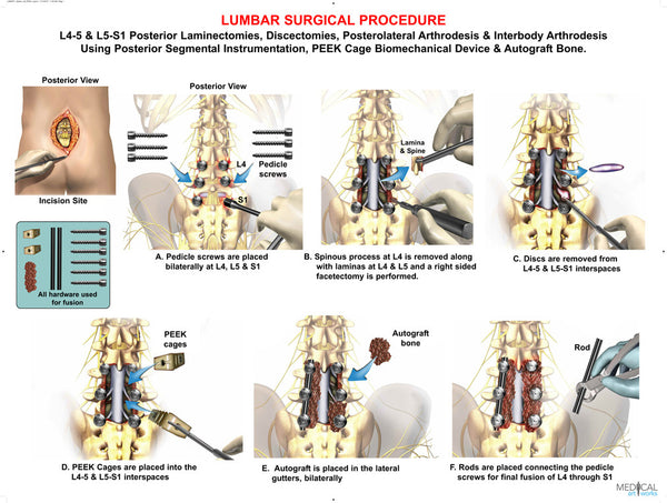 2 Level L4 5 And L5 S1 Posterior Lumbar Interbody Fusion Surgery