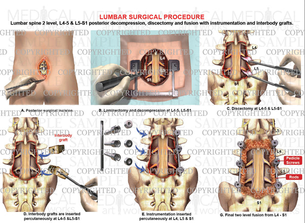 2 Level L4 L5 S1 Posterior Lumbar Interbody Fusion Decompression