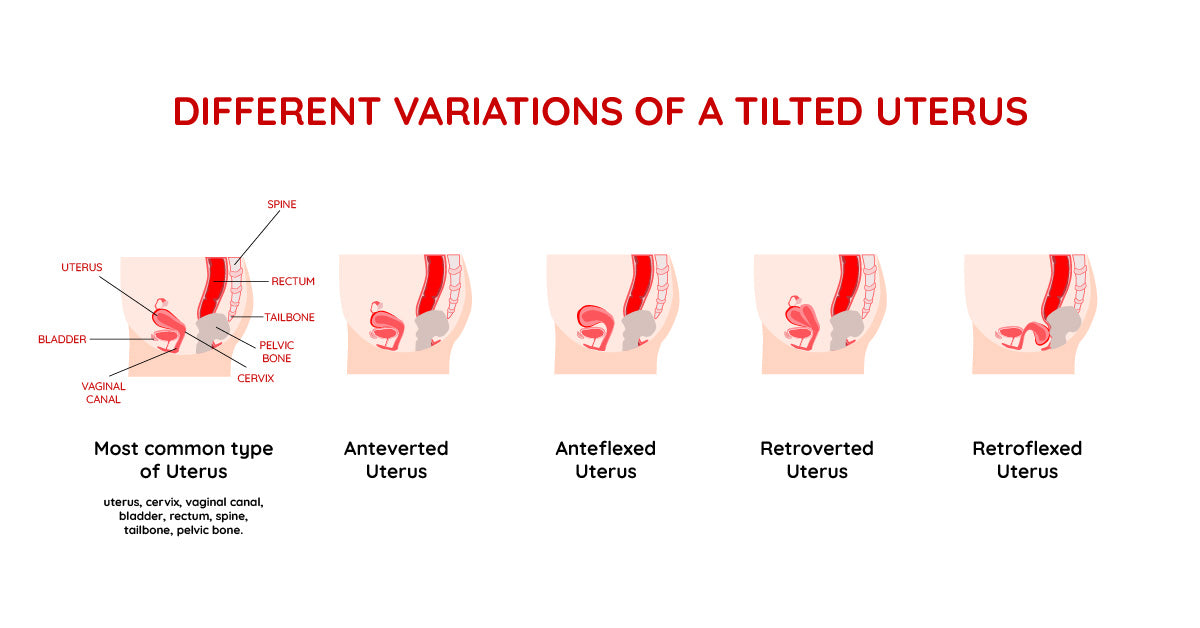 Retroverted Uterus Cervix Position